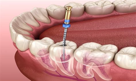 Advanced Microscopic Root Canal In Andheri Mumbai