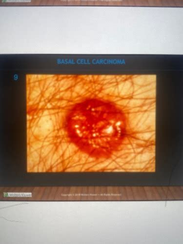 Soft Tissue Lesions Flashcards Quizlet