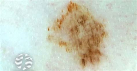 Dermnet® Fibrillar Pattern Image