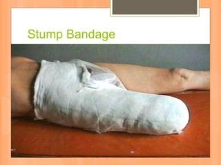 Amputations In Limbspptx