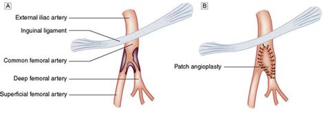 Vascular And Endovascular Surgery Clinical Gate
