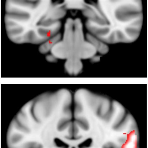 Group Difference In Bilateral Insula Cortex Figure 1 Depicts
