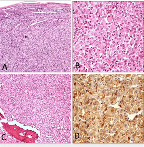 A Low Power View Showing Sheets Of Cells With Plump Eosinophilic