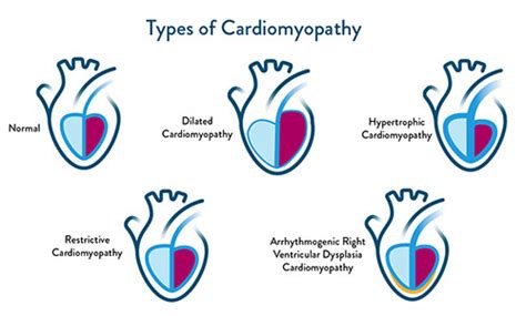 Cardiomyopathy Faqs Abbott