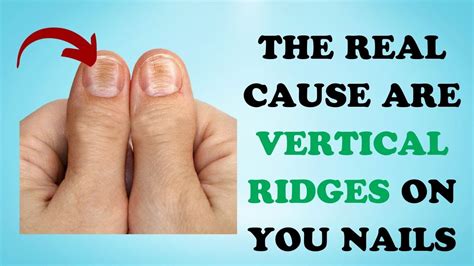 6 Causes Of Vertical Lines On Your Nails Healthy Care YouTube