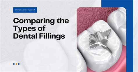 Types Of Dental Fillings Pdf At Betty Fleming Blog