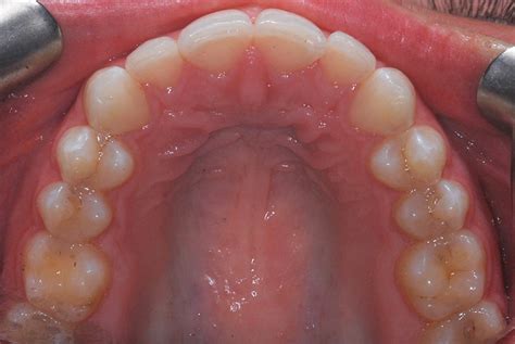 Setting The Stage For Porcelain Veneers Oral Health Group