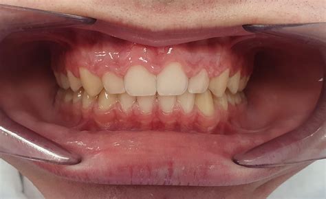 You Can Eat Everything With Braces You Just Need To Be More Careful