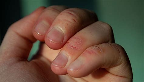 Дерматит что это как выглядит виды симптомы и лечение