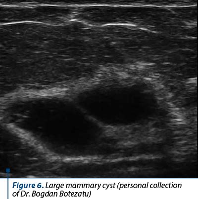 Correlation Between Vitamin D Deficiency And Fibrocystic Mastopathy