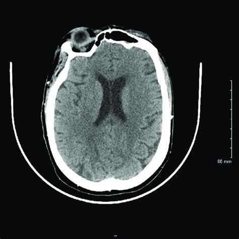 Computed Tomography Ct Scan Of The Head Done On The Day Of Admission