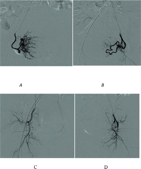 A And B Bilateral Uterine Artery Angiography Showed Distortion And