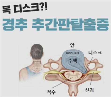 목디스크 예방 베개 높이 목디스크 증상 및 치료방법 And 목디스크를 지키는 운동법 목디스크 지키는 생활 습관 네이버 블로그