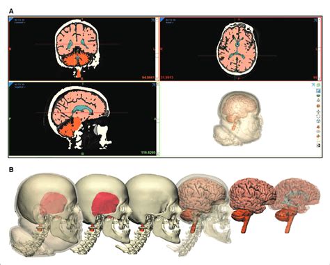 Segmentation And Rendering Process A Neuroimaging Data Used For 3d