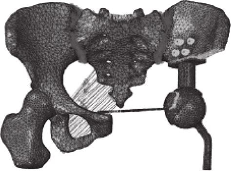 The Finite Element Fe Pelvic Model After Type Ii Resection And