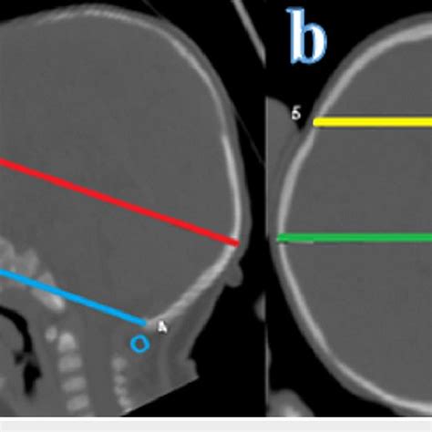 Cephalic Index Measurement A Cephalic Index Measurement Plane In