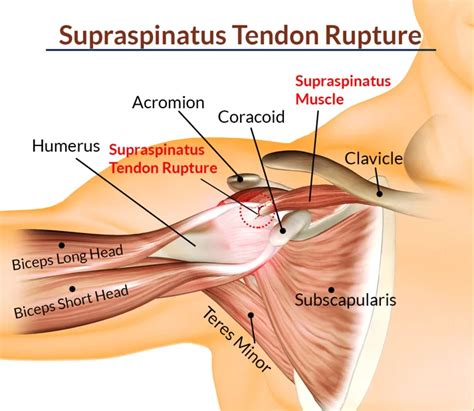 Supraspinatus Tendon
