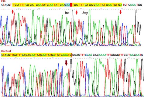 Sanger Sequencing Confirmation Of A C 1842 1865dup And Download Scientific Diagram