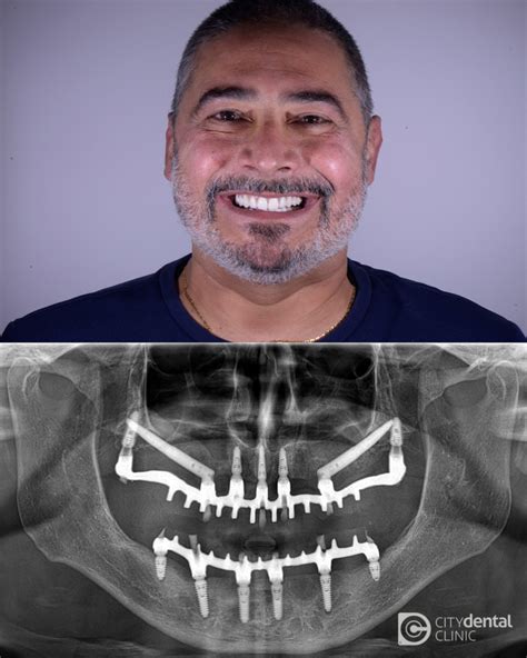 Zygomatic Implants In Albania City Dental Clinic