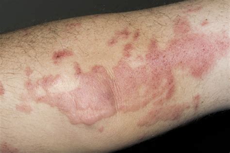 Apa Itu Dermatitis Kenali Bahaya Dan Penanganannya Information