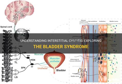 Understanding Interstitial Cystitis Exploring The Bladder Syndrome