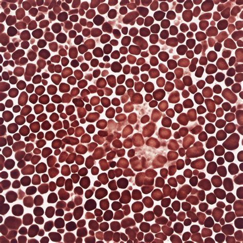 Ai Tool Hits 100 Accuracy In Melanoma Detection