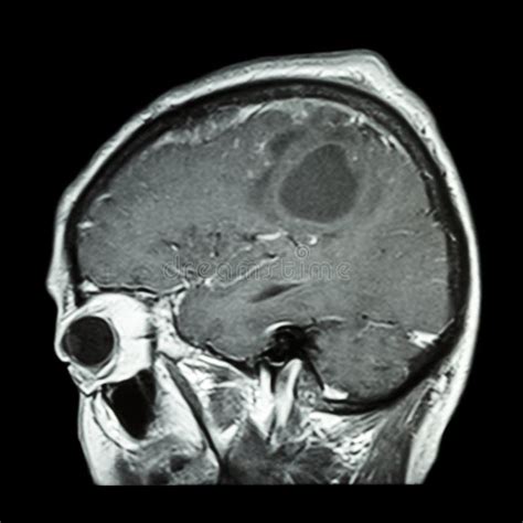 摄制脑子mri与脑瘤纵分面、侧视图，医疗侧向的看法 医疗保健，科学背景的 库存图片 图片 包括有 医生 大脑 58960833