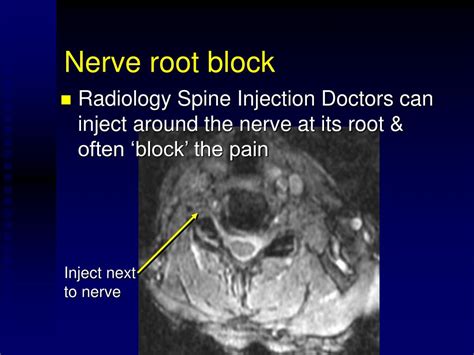 How Does A Nerve Root Block Work At Nickole Williams Blog