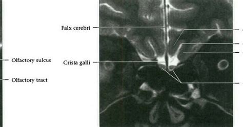 Dr Balaji Anvekar Frcr Cranial Nerves Normal Mri Anatomy 57 Off