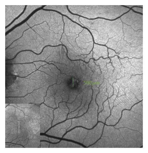 Blue Fundus Autofluorescence A And Optical Coherence Tomography Oct Download Scientific