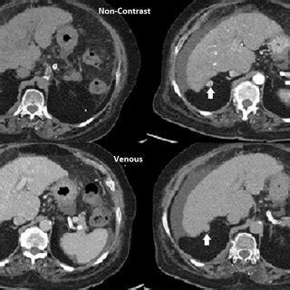 Quadriphasic Contrast Enhanced CT Scan Images Showing The Exophytic