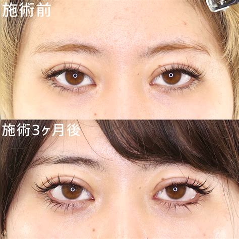 切らないタレ目形成で柔らかい眼差しへ【グラマラスライン形成】｜症例写真・ビフォーアフター｜美容整形･美容外科のtaクリニックグループ
