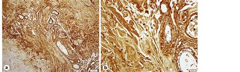 Tissue Immunostaining Of The Biopsy Specimen Of The Left Lacrimal Gland