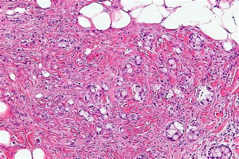 Goblet Cell Carcinoid Alchetron The Free Social Encyclopedia