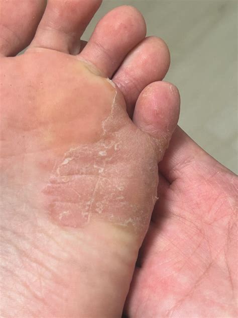 발바닥 습진 어떻게 없애나요 지식in