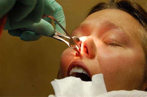 Nose Splints What Are They Are They Really Needed Westside Sinus