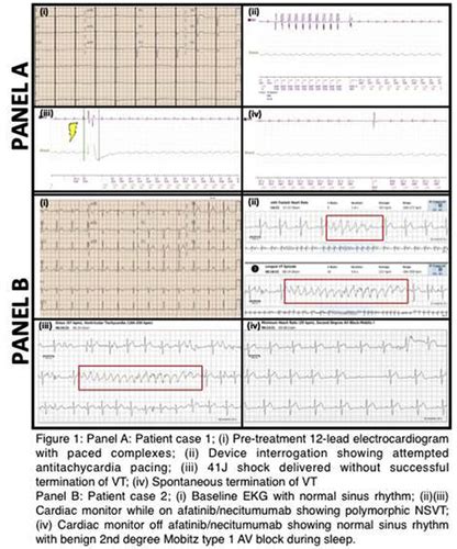 Tyrosine Kinase Inhibitor Associated Polymorphic Ventricular Tachycardia Jacc Cardiooncology