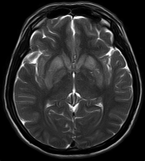 Rabies Encephalitis Applied Radiology
