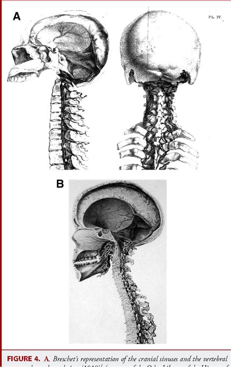Figure 4 From History Of The Vertebral Venous Plexus And The