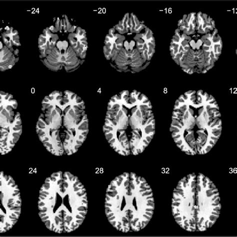 statistical parametric maps showing group differences greater