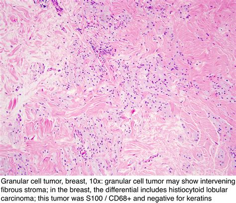 Granular Cell Tumor
