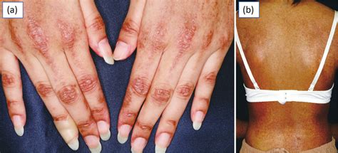 Skin Findings On Admission Initial Physical Examination Revealed
