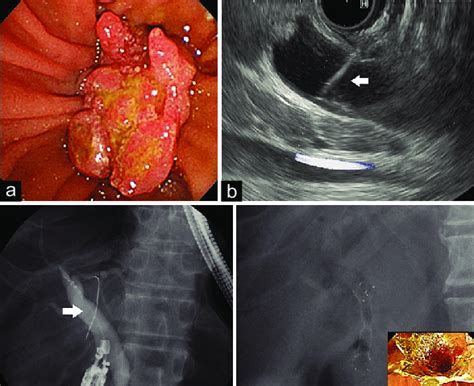 A Case Of Failed Ercp For Carcinoma Of The Duodenal Papilla A Download Scientific Diagram
