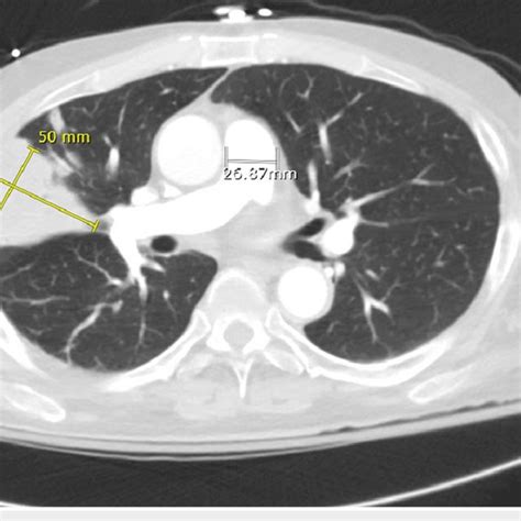Axial View Of Ct Chest Also Demonstrating A Dominant Mass In The Right