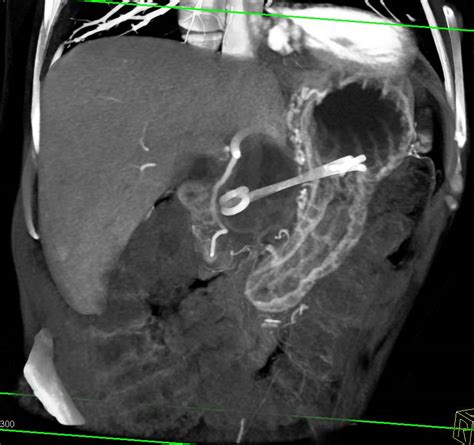 Cystogastrostomy With Good Visualization Of Pigtail Catheter Into