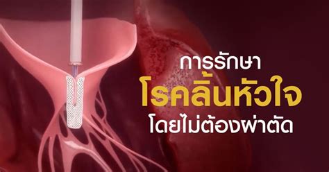 Bumrungrad International โรคลิ้นหัวใจรักษาได้โดยไม่ต้องผ่าตัด