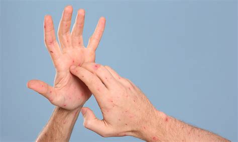 Understanding Infectious Skin Conditions