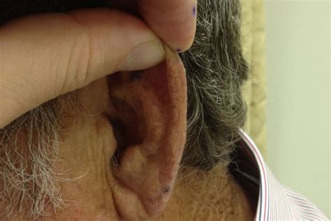 Derm Dx Dark Papules After Stage Ia Melanoma Clinical Advisor