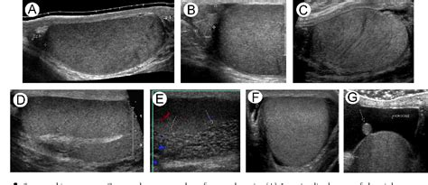 Figure 2 From Scrotal Ultrasound In Adults Semantic Scholar