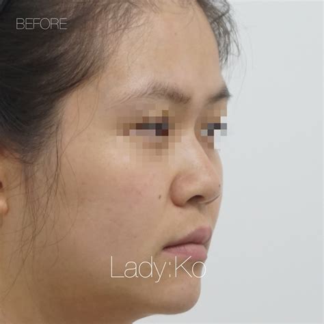 하이코 코필러 말고 코리프팅 𝐋𝐚𝐝𝐲 𝐂𝐥𝐢𝐧𝐢𝐜 레이디코 신원장님 언제쯤 자연스럽게 촬영할 수 있을까여ㅋㅋ 코필러 하이코 코실리프팅 콧대 코끝 연말